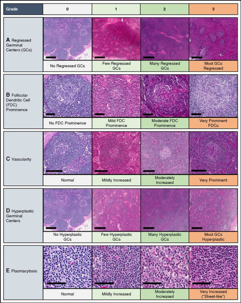 Maladie de Castleman : Diagnostic et classification - Castleman