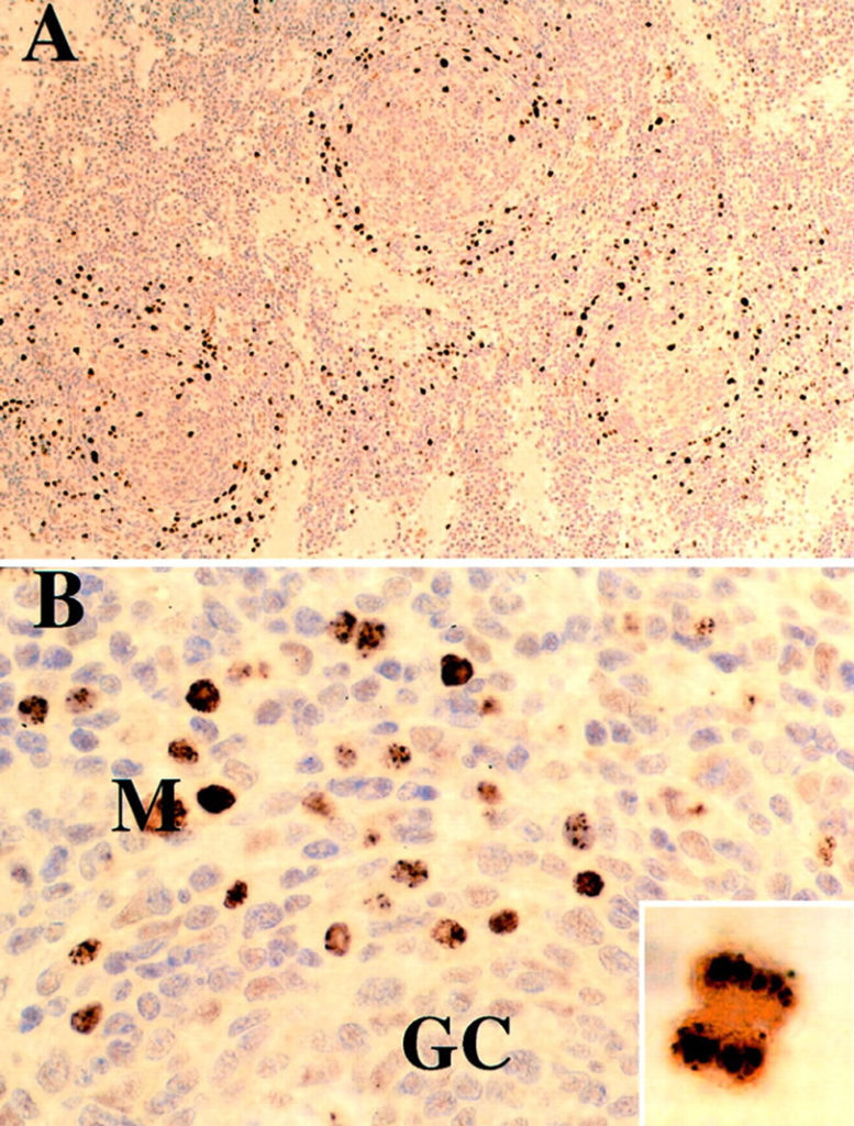 Maladie de Castleman : Diagnostic et classification - Castleman